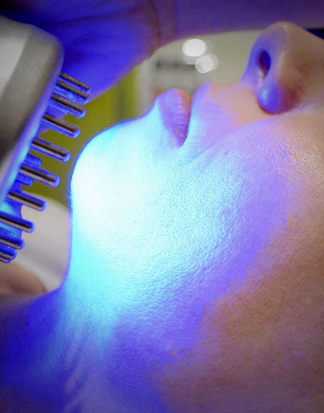 How LED light therapy can help acne-prone skin | Figaro London