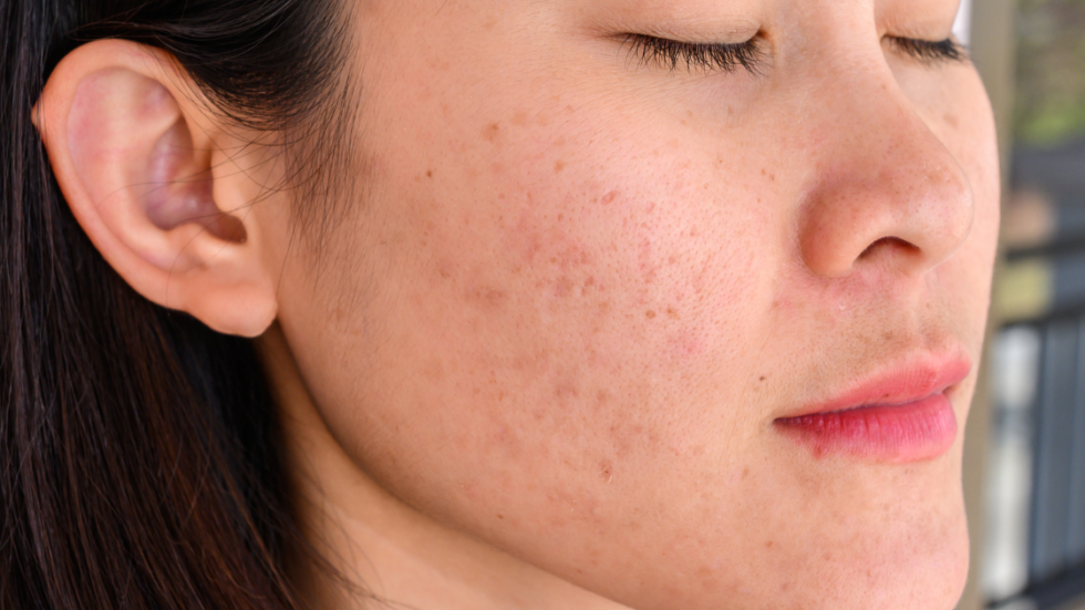 Exploring Solutions for Melasma | A Guide to Non-Invasive Facials